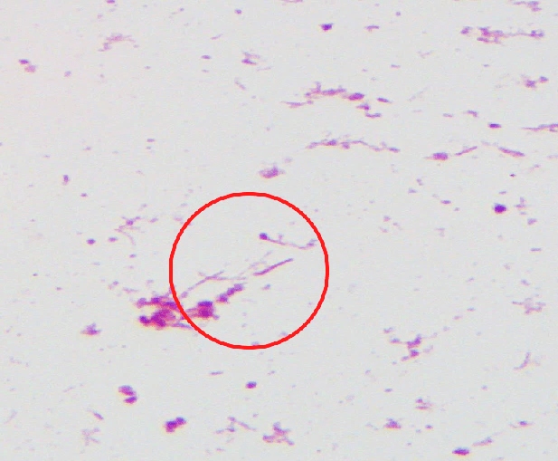 Microbiology Case Study: A 54 Year Old Male with Shortness of Breath ...