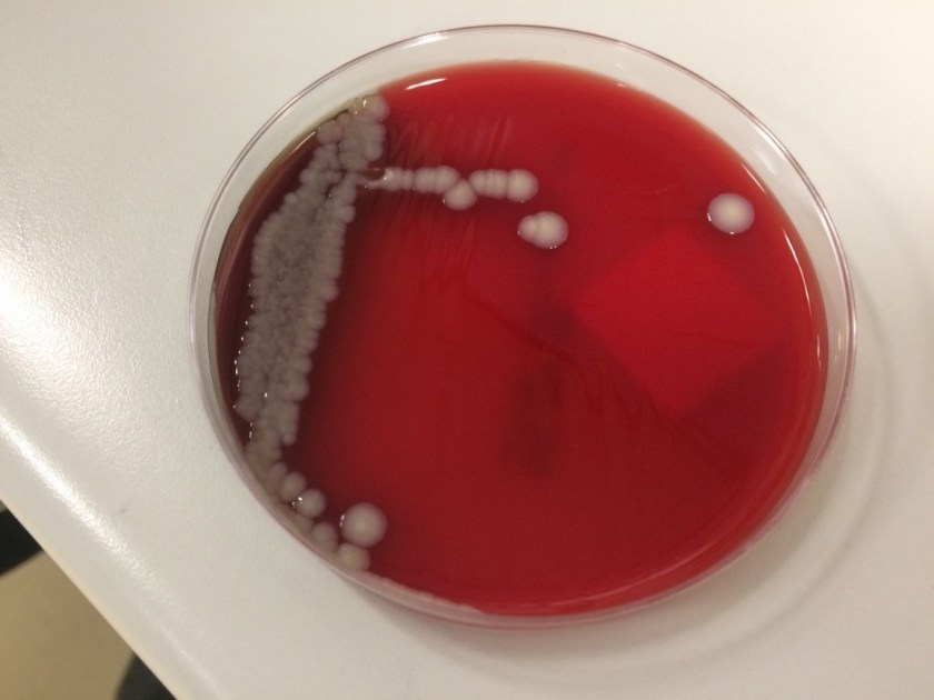 Microbiology Case Study: A 31 Year Old Man with History of IV Drug Use ...