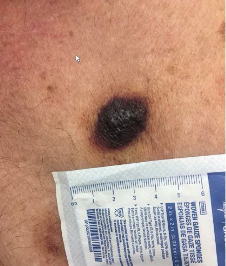 Hematopathology Case Study: A 65 Year Old Male with a Skin Lesion on ...