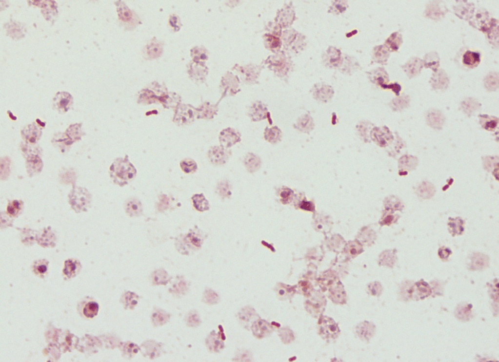 Microbiology Case Study: A 58 Year Old Female with Shortness of Breath ...