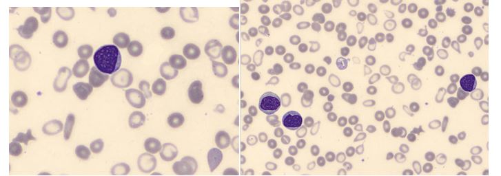 Hematology Case Study: Symptomatic Anemia in Myelodysplastic Syndrome ...