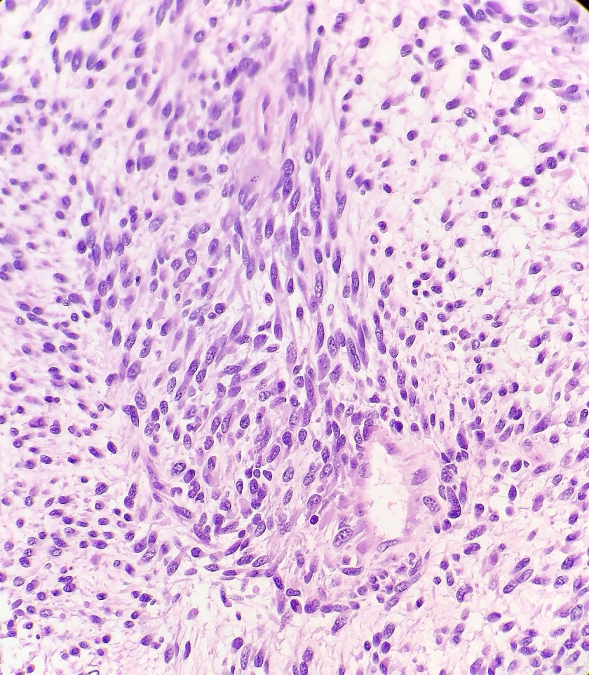 Surgical Pathology Case Study: A 42 Year Old Woman with an Enlarging ...