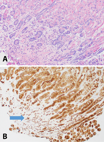 Gastric Cancer: A Multidisciplinary Approach – Lablogatory