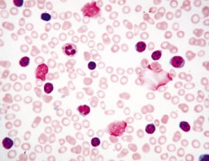 Smudge Cells: Artifacts or Clinically Significant? – Lablogatory