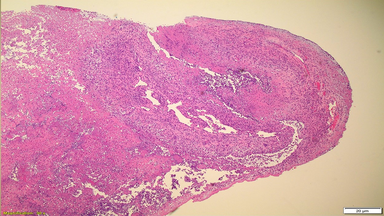 Microbiology Case Study: a 49 Year Old Man with Chest Pain and ...