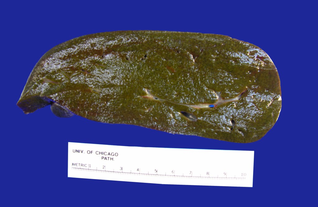 Surgical Pathology Case Study: A 2.5 Year Old Male Who Presents with ...