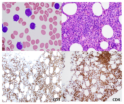 Hematopathology Case Study: A 77 Year Old Man with Rash – Lablogatory