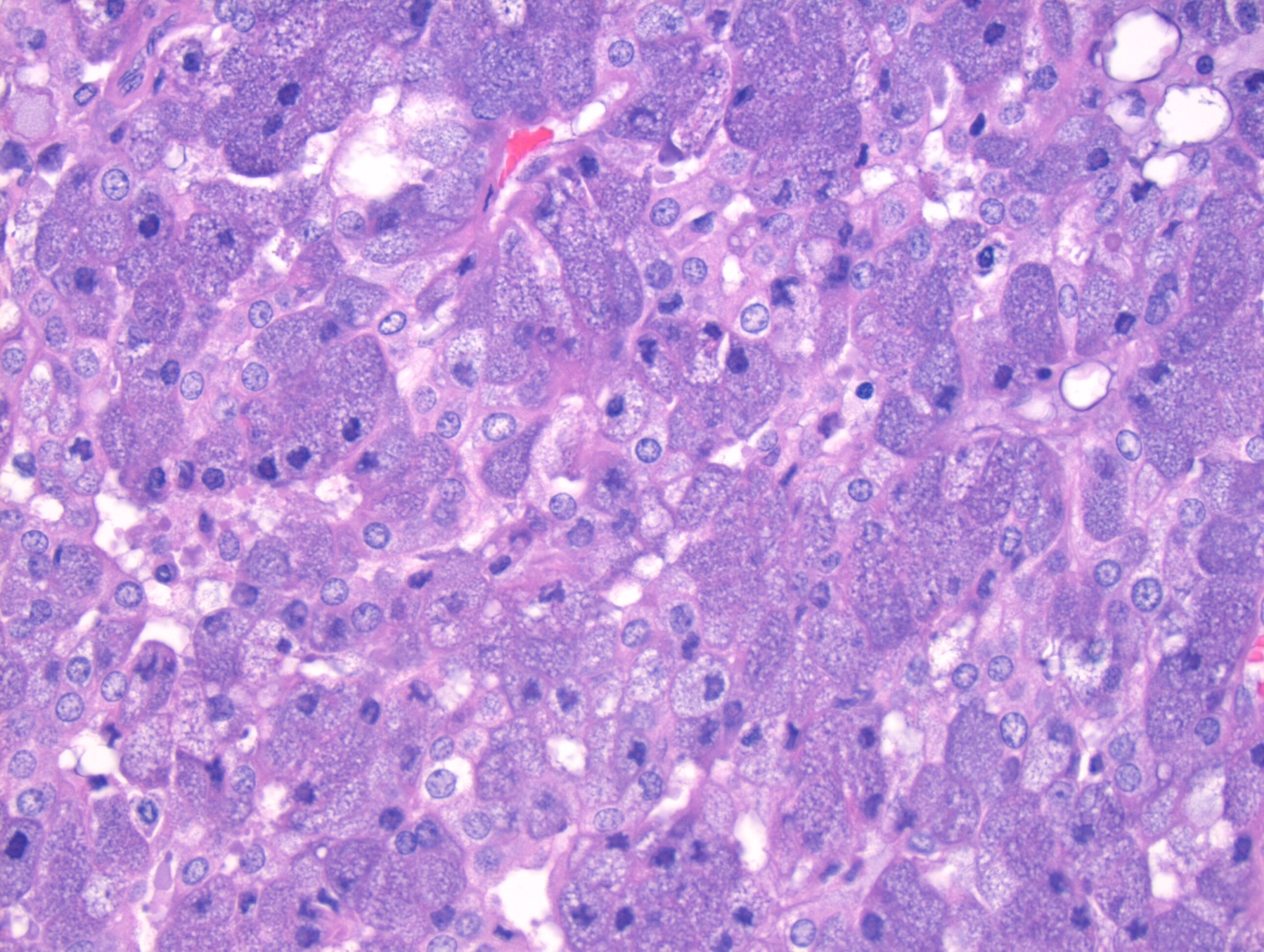 Surgical Pathology Case Study: An Enlarging Neck Mass with A Non-Diagnostic FNA – Lablogatory
