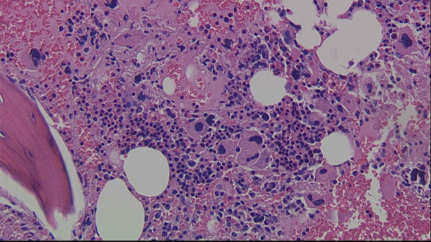 Hematopathology and Molecular Diagnostics Case Study: A 63 Year Old Man ...