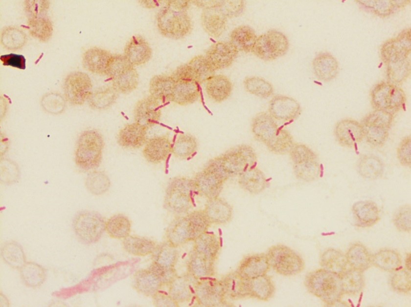 Microbiology Case Study: A 60 Year Old with Non-Healing Wound – Lablogatory