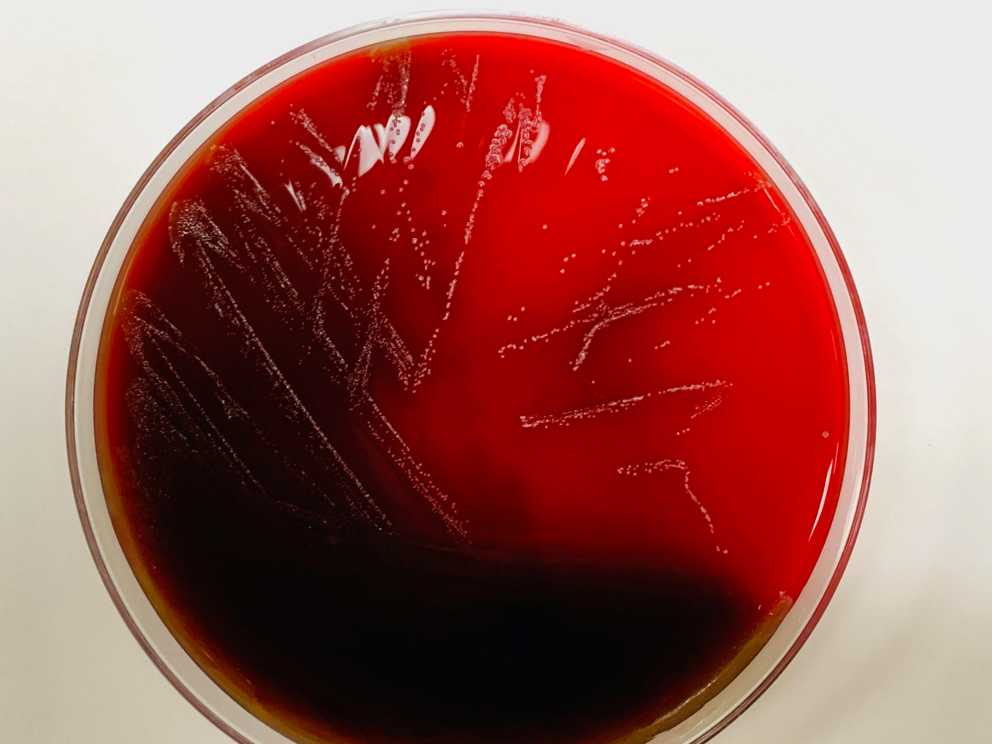 Microbiology Case Study: An 80 Year Old Man with Dyspnea, Fatigue, and ...