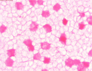 transfusion medicine – Lablogatory