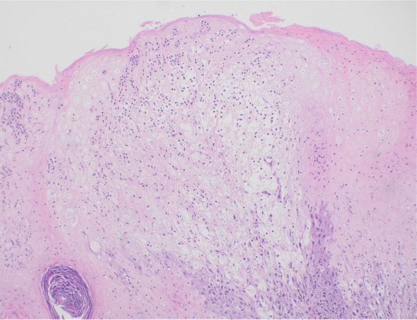 The Latest Pox, Up Close and Personal – Lablogatory