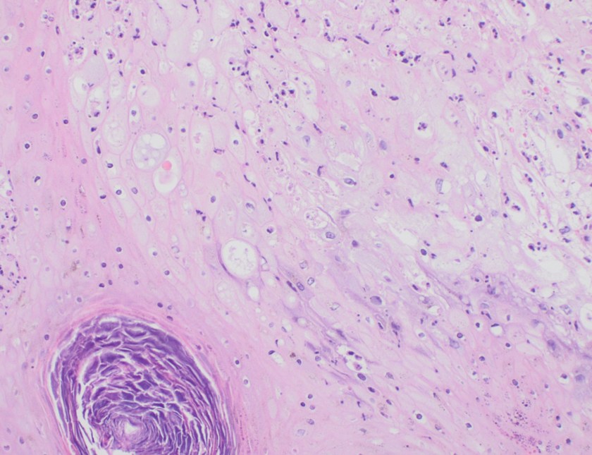 The Latest Pox, Up Close and Personal – Lablogatory