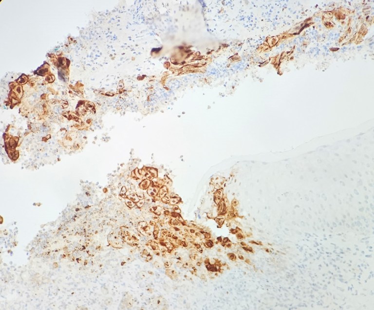Microbiology Case Study: An Unusual Case of Herpes Reactivation ...