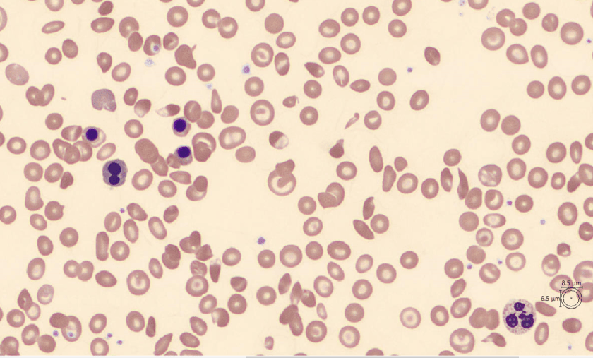 Case Studies in Hematology: Hemoglobin S Beta Thalassemia Compound ...
