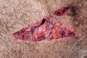 Blunt Versus Sharp Force Injuries: A Primer on Terminology – Lablogatory