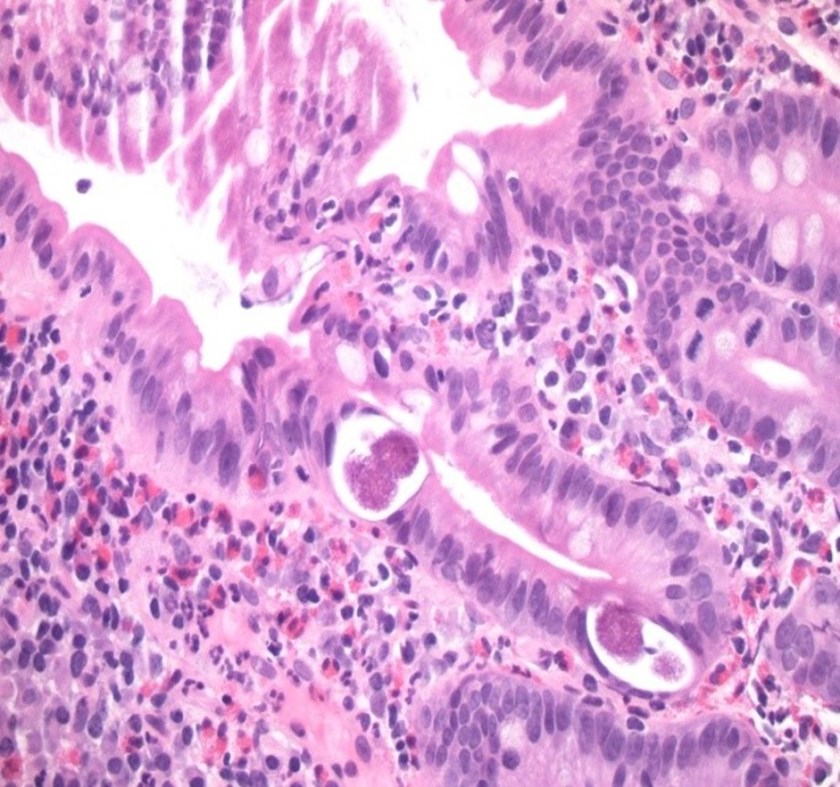 Incidental Finding of Parasitic Infection in a 75 Year Old Male with ...