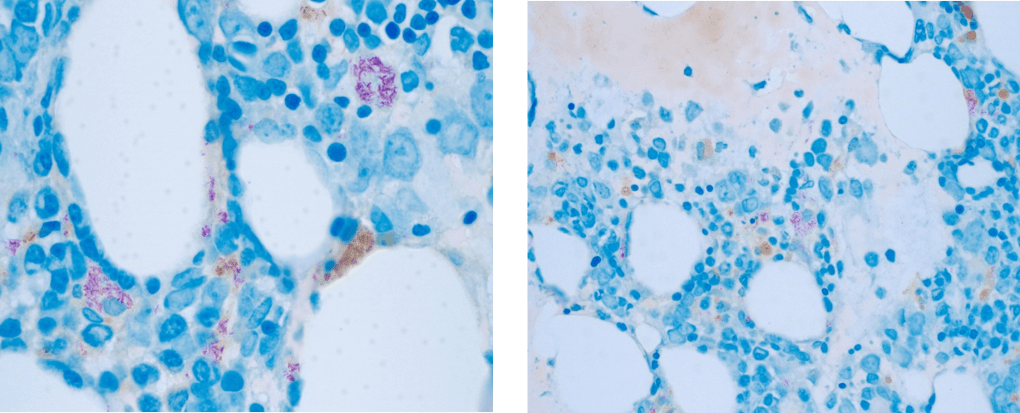 Microbiology Case Study: Disseminated Disease Confirmed by Bone Marrow ...
