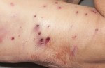 Introduction to Shotgun Wounds – Lablogatory